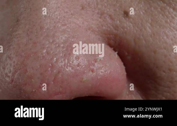 Squeezing pimples on the nose with hands. Pushing and squeezing to ...