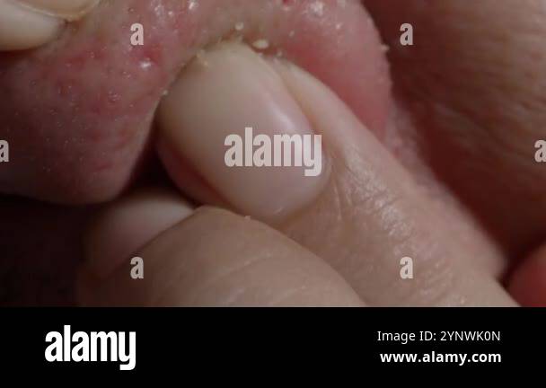 Squeezing pimples on the nose with hands. Pushing and squeezing to ...