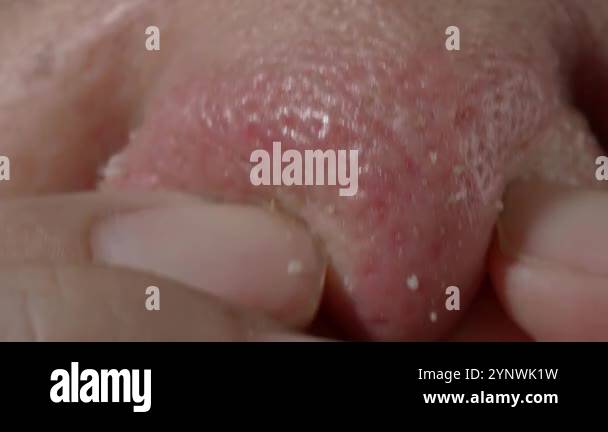 Squeezing pimples on the nose with hands. Pushing and squeezing to ...