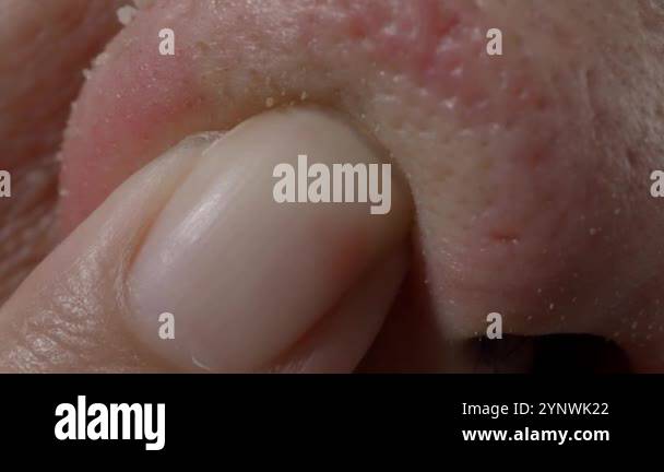 Squeezing pimples on the nose with hands. Pushing and squeezing to ...