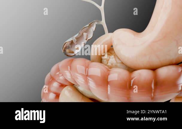 Gallstones in the gallbladderand bile duct, human silhouette and ...
