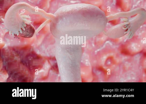 Ovarian malignant tumor, Female uterus anatomy, Reproductive system ...
