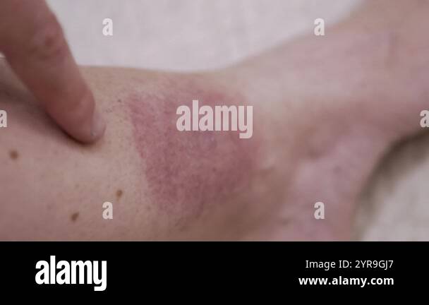 Close up, Formation of a Large Red Spot on the Skin from a Tick Bite ...