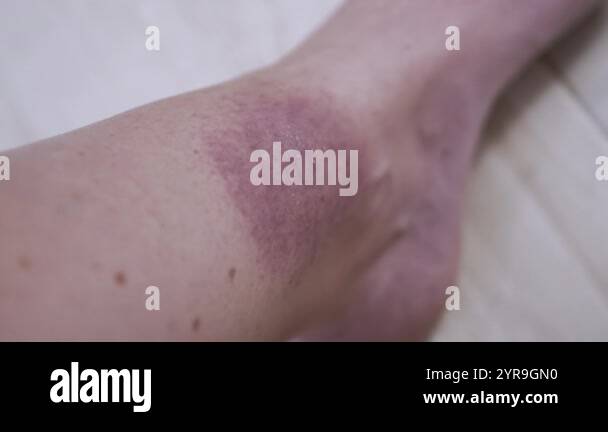 Close up, Formation of a Large Red Spot on the Skin from a Tick Bite ...