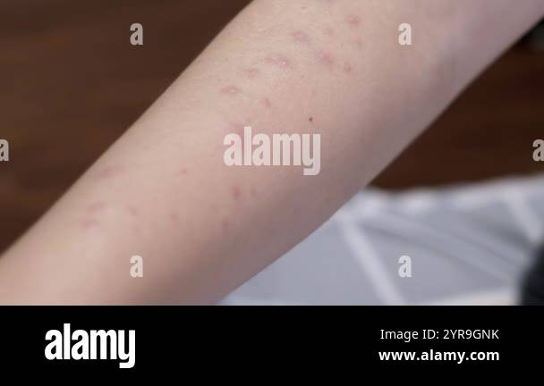 Close up of a skin rash on a female arm, possibly an allergy or ...