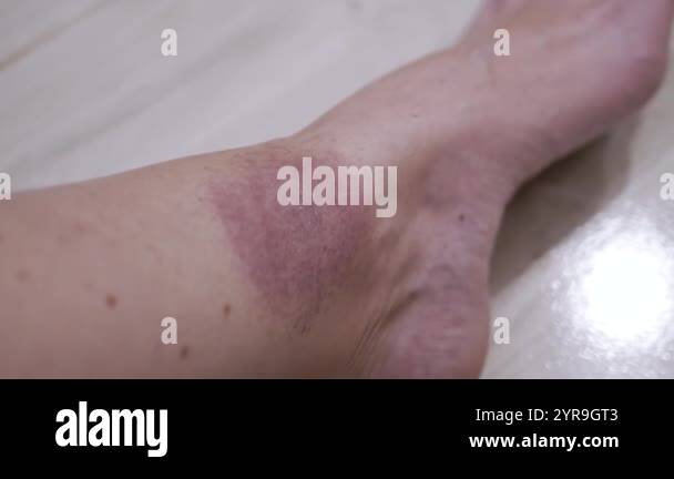 Close up, Formation of a Large Red Spot on the Skin from a Tick Bite ...