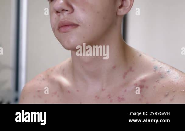 Thoughtful teenager with chickenpox rash on his chest and shoulders ...