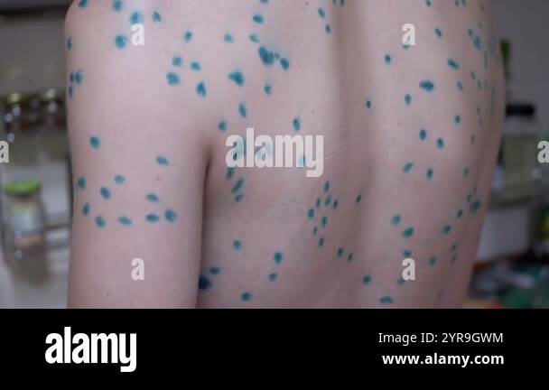 Close-up shot of a persons back with blue marks. The shot is static ...