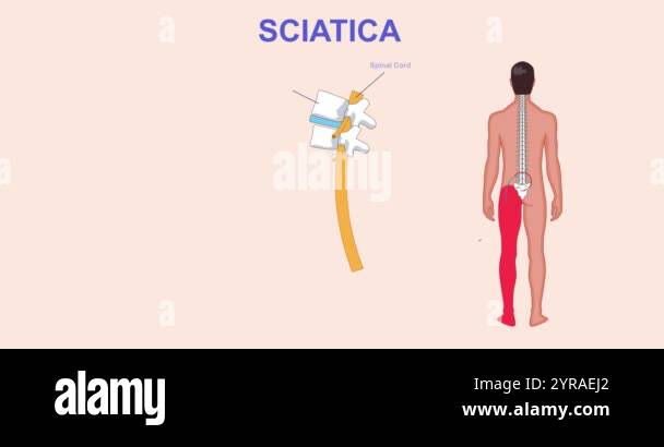 Infograhics with sciatica. Moving banner with mans spine. Healthcare ...
