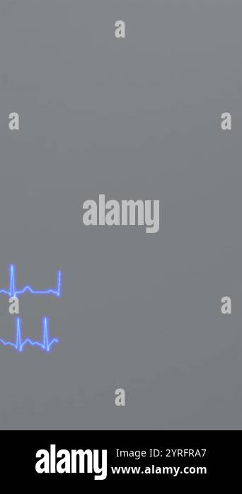 Comparison of ECG of normal heart rhythm and tachycardia Stock Video ...