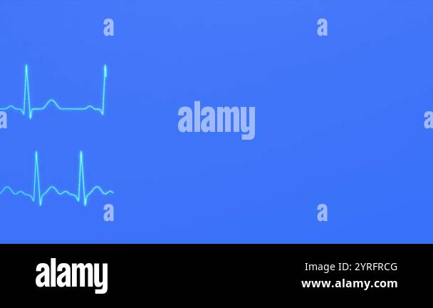 Comparison of ECG of normal heart rhythm and tachycardia Stock Video ...