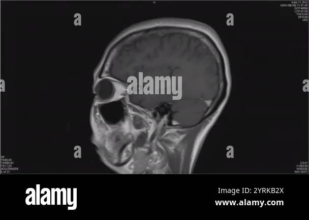 Magnetic resonance images of the brain, MRI of the brain, of a patient ...
