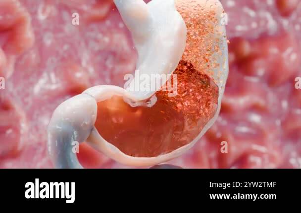 Stomach Acid Relux. Esophagus, gerd. Pain In The Digestive System ...