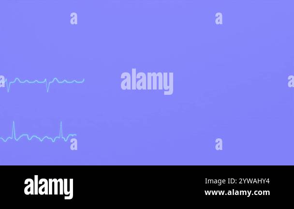 ECG graphs of regular and irregular atrial flutter Stock Video Footage ...