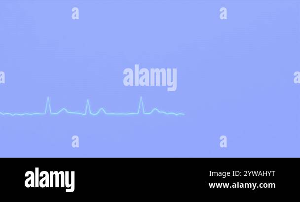 ECG graph of atrial fibrillation, 3d animation render Stock Video ...