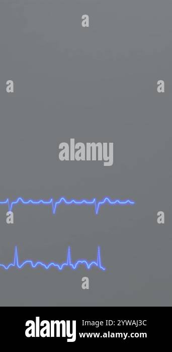ECG graphs of regular and irregular atrial flutter Stock Video Footage ...