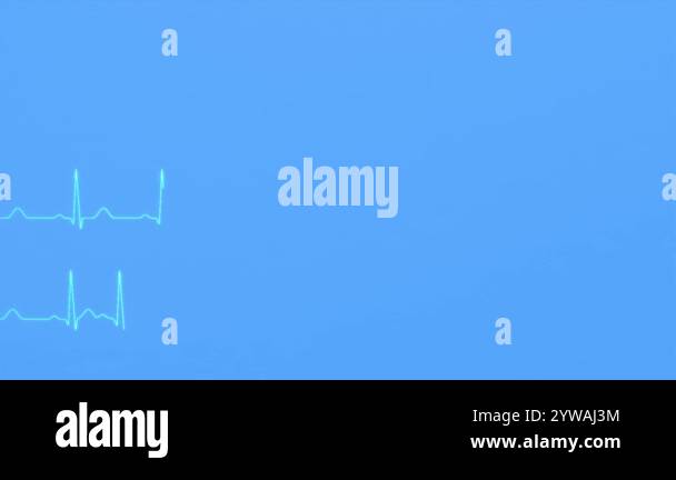 ECG graphs comparison of normal heart rhythm and arrhythmia Stock Video ...