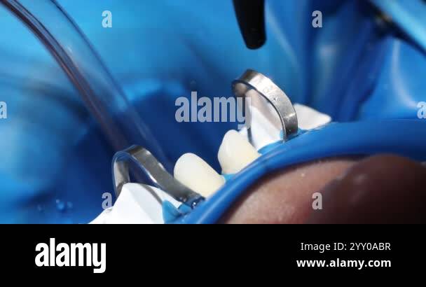 Professional dentist uses air stream to dry teeth of patient. Doctor ...