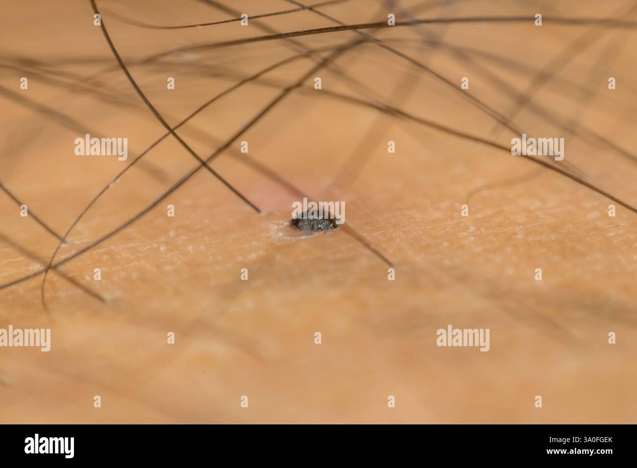 Macro of dry skin asian human with black hairy and dermatology and ...