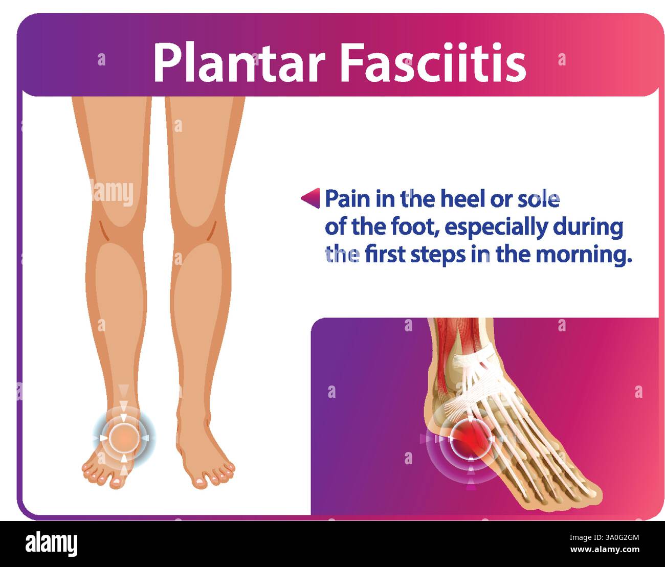 Illustration of foot pain and plantar fasciitis symptoms Stock Vector ...