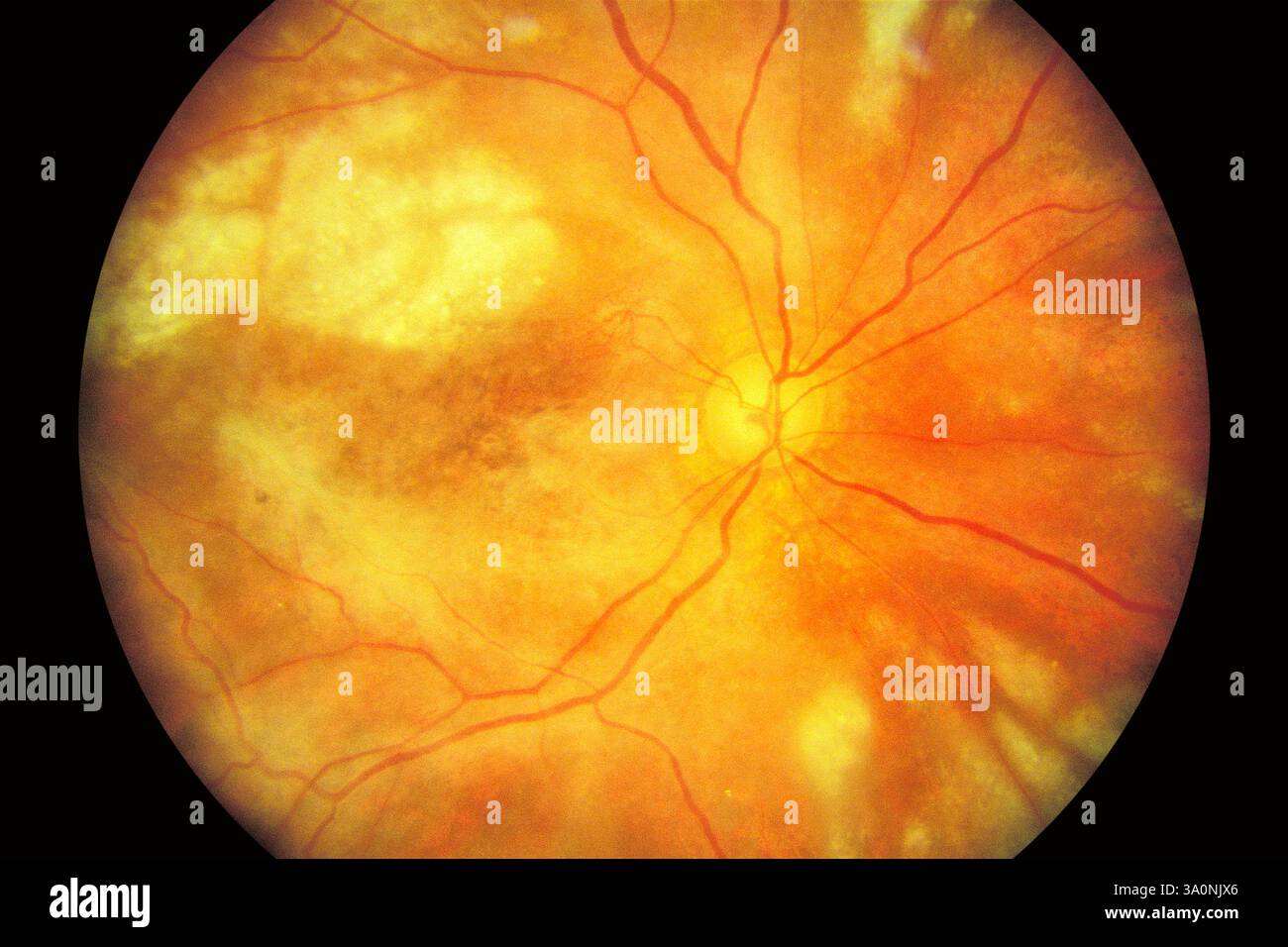 Chorioretinitis, fundus photograph. View of the interior surface of a ...