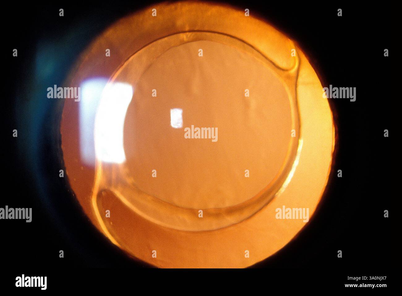 Eye with artificial lens. Close-up of an intraocular lens (IOL ...