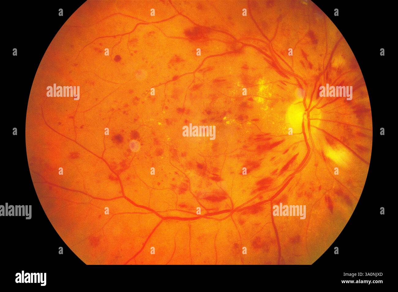 Diabetic retinopathy, fundus photograph. View of the interior surface ...