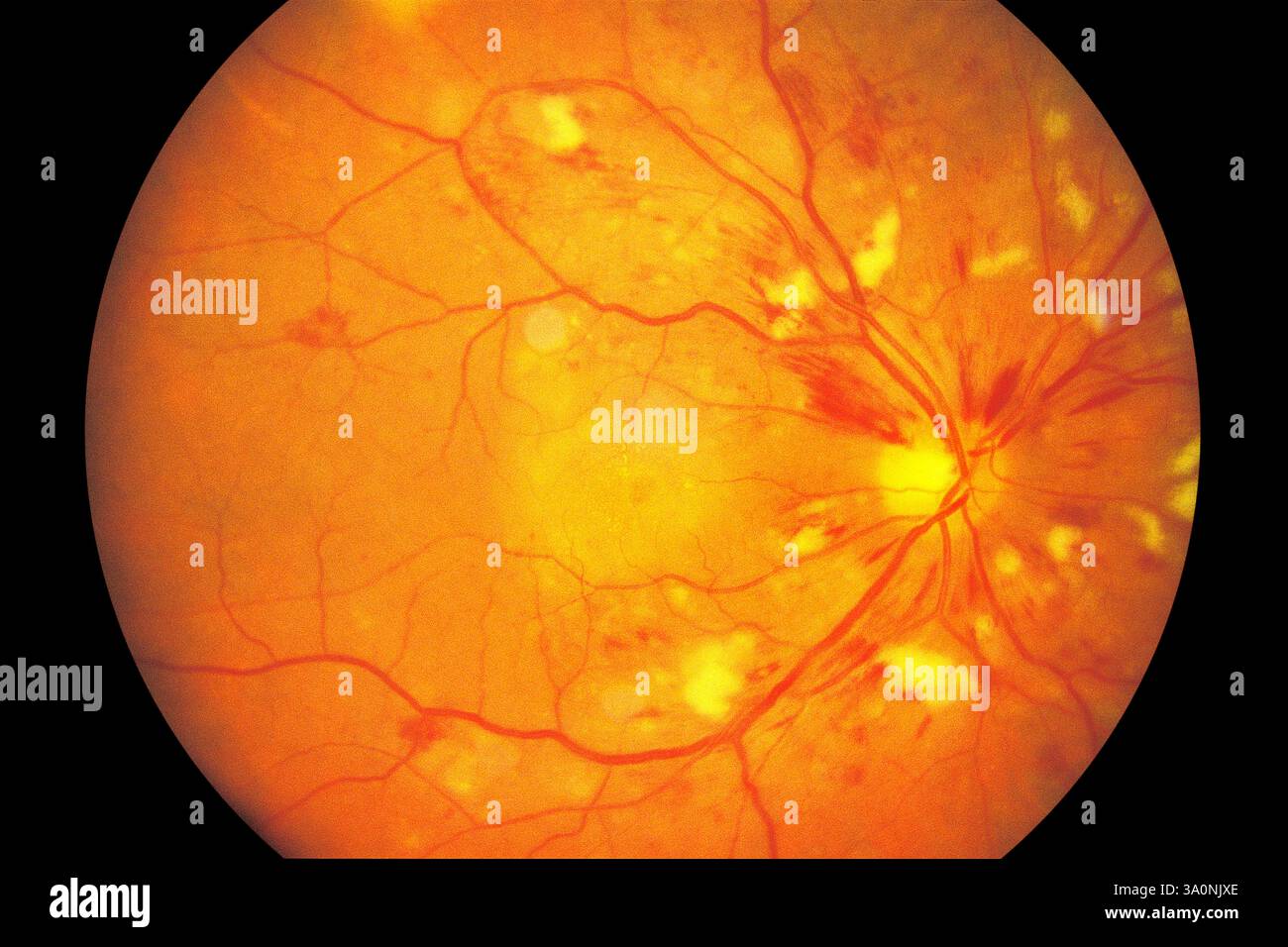 Hypertensive retinopathy, fundus photograph. View of the interior ...