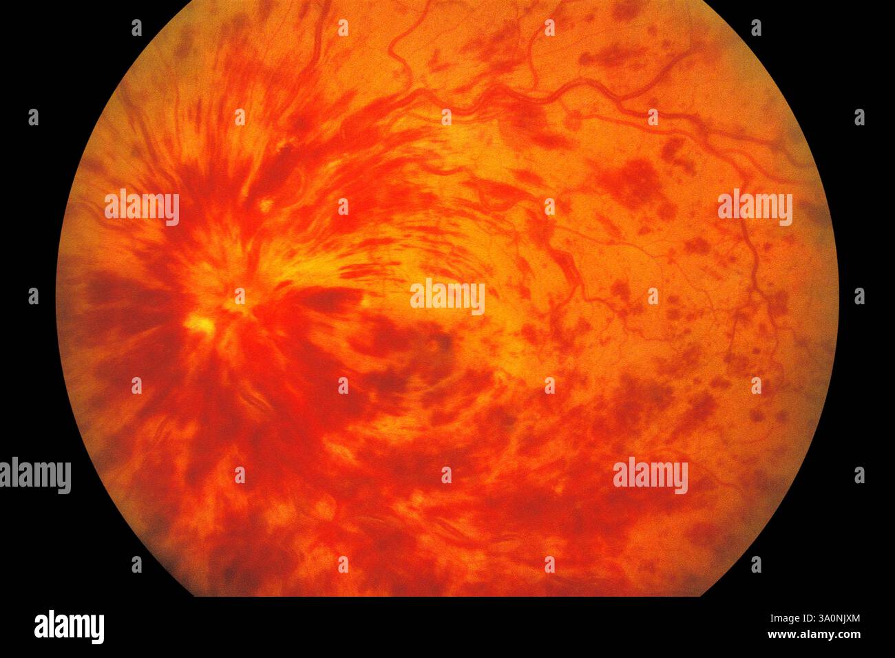 Retinal haemorrhages, fundus photograph. View of the interior surface ...