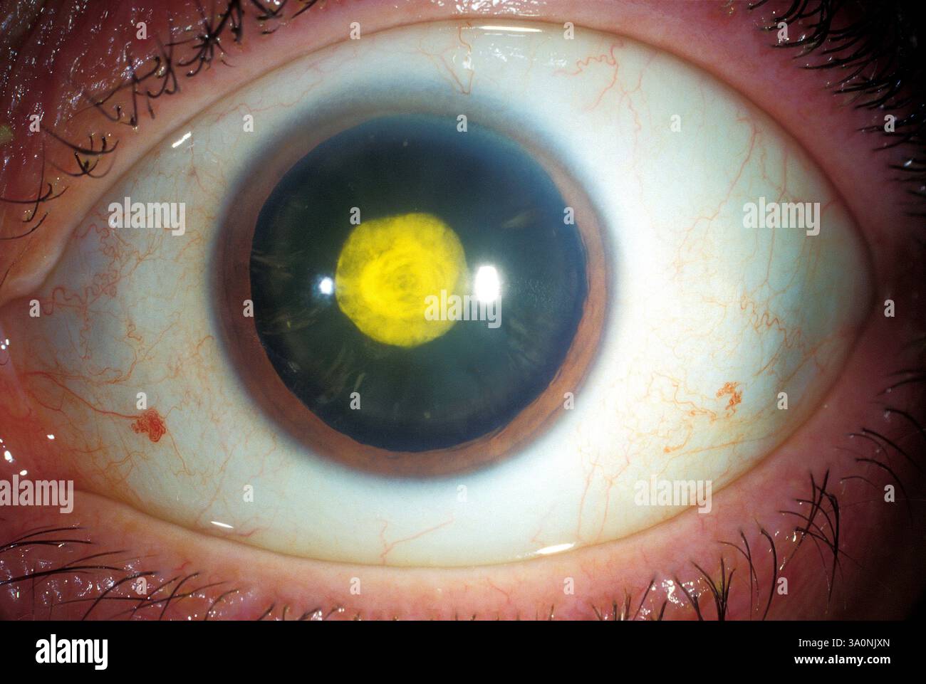 Congenital rubella cataract. Close-up of the left eye of a patient with ...