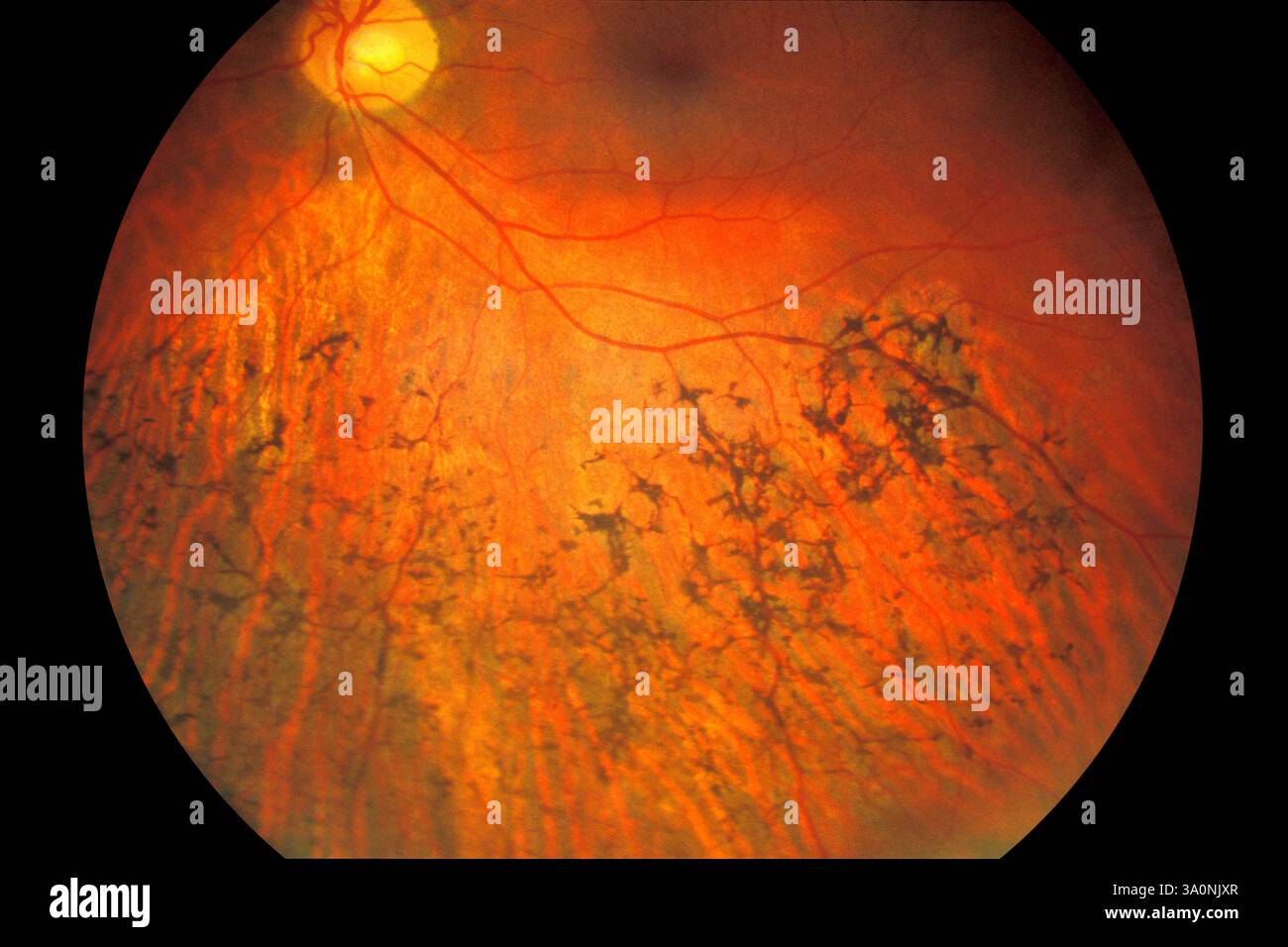 Retinitis pigmentosa, fundus photograph. View of the interior surface ...