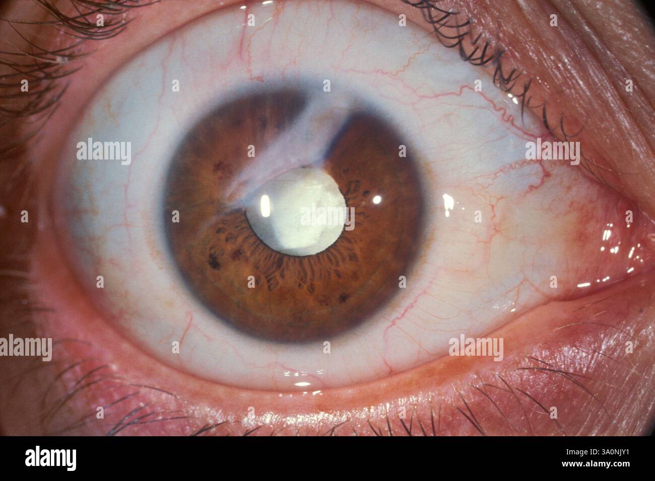 Traumatic cataract with corneal scar in a patient's right eye. A ...