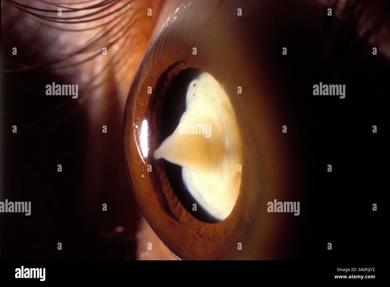 Congenital pyramidal cataract. Slit-lamp examination of a congenital ...