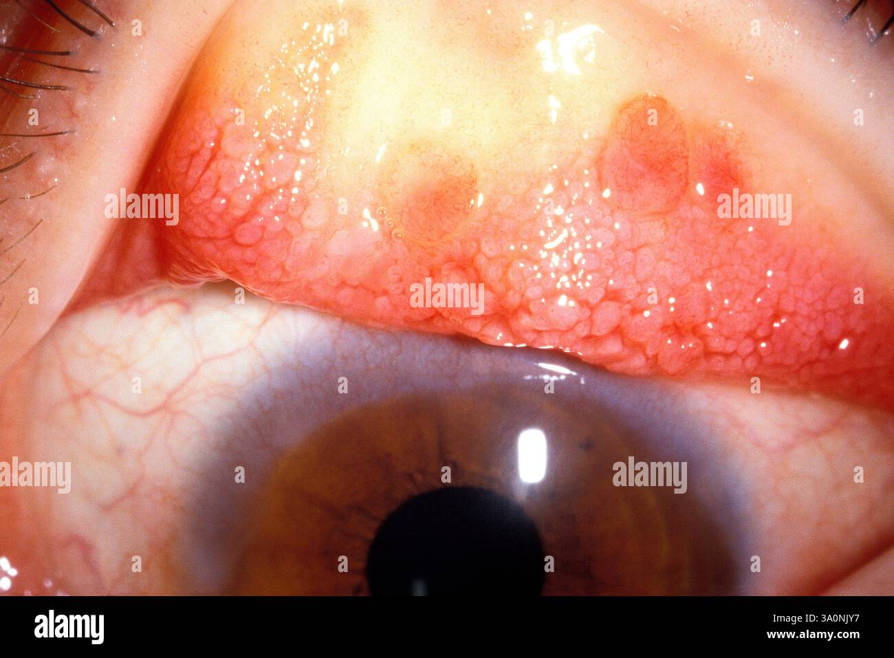 Giant papillary conjunctivitis. Inflammation and large lesions on the ...