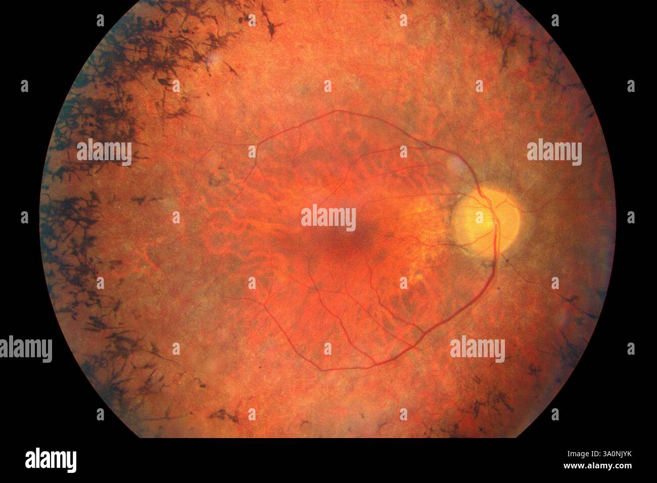 Pigmentary retinopathy. Fundoscopy image of the retina of the right eye ...