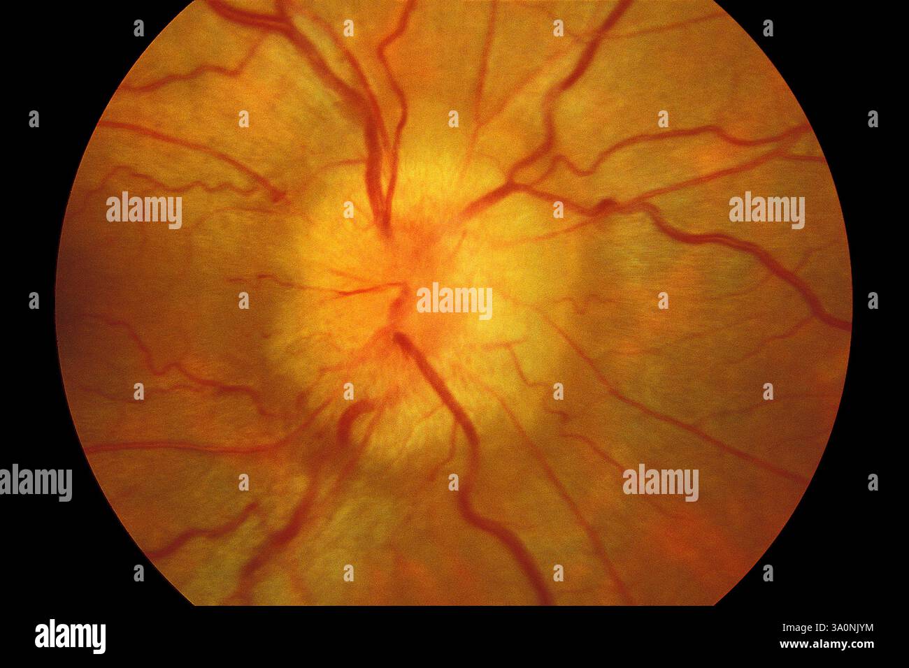 Oedema of the optic disc. Fundoscopy image of the retina of the right ...
