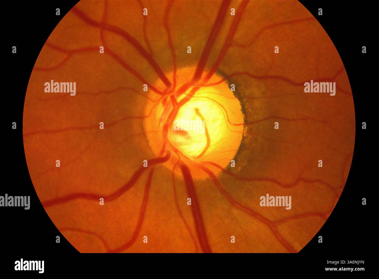Open-angle glaucoma. Fundoscopy image of the retina of the left eye of ...