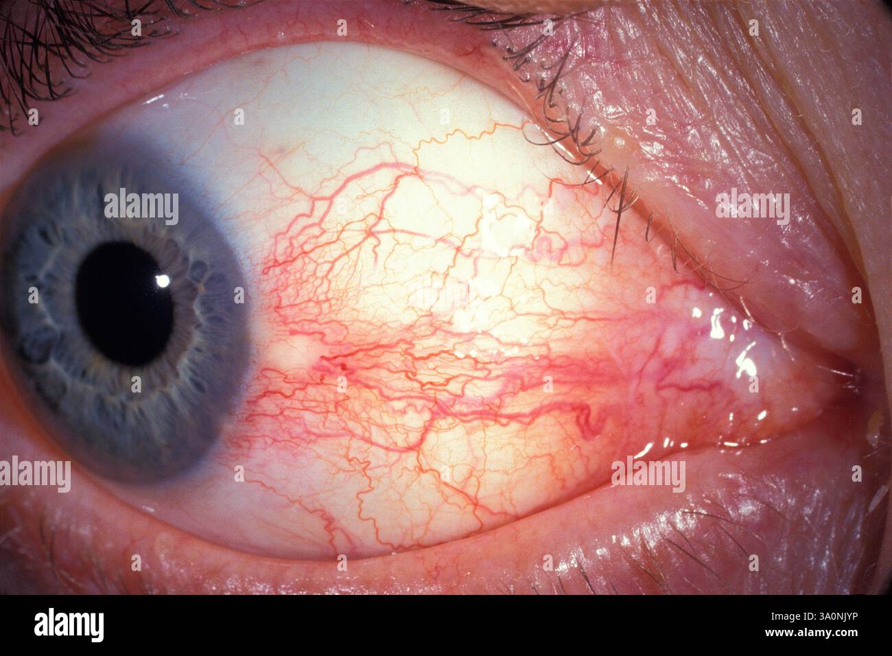 Episcleritis. Close-up of the right eye of a patient with episcleritis ...