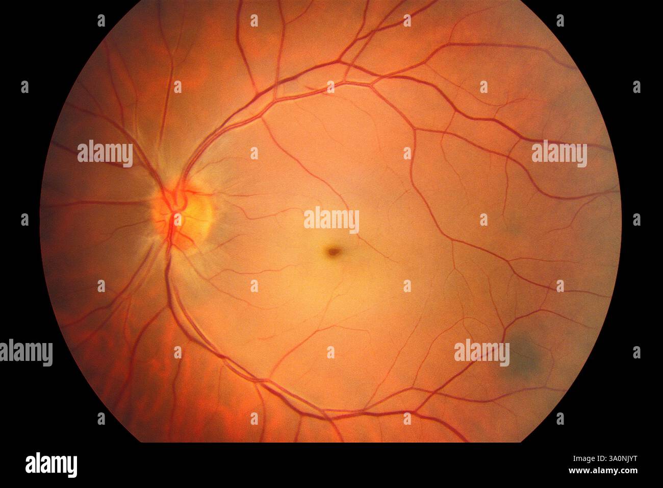 Occlusion of the central retinal artery. Fundoscopy image of the retina ...