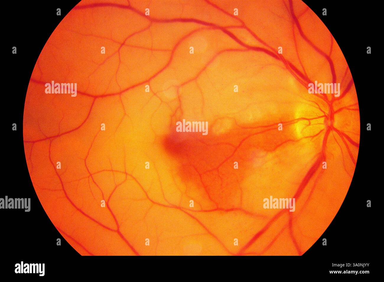 Occlusion of the central retinal artery. Fundoscopy image of the retina ...