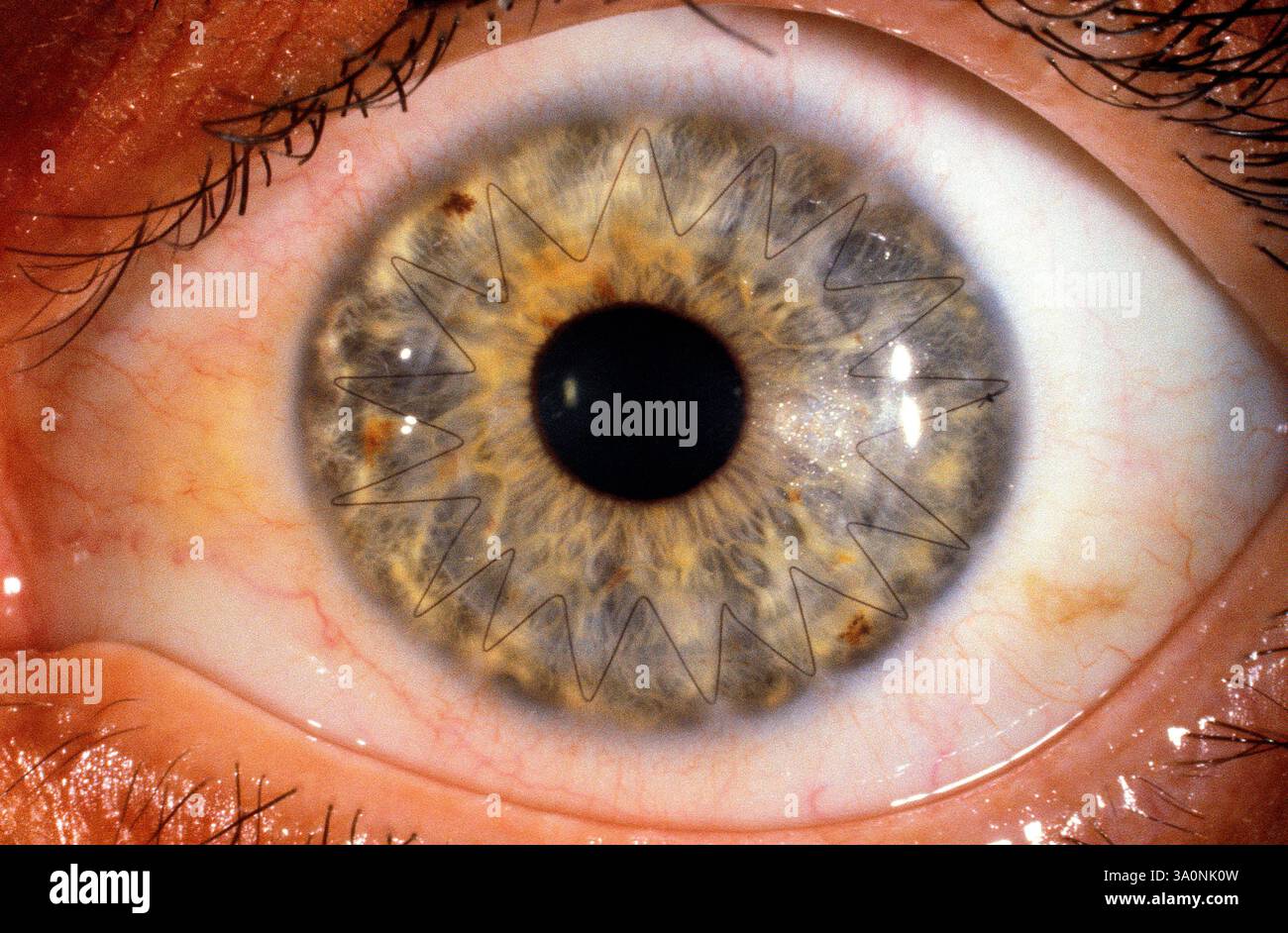 Corneal graft. Close-up of the left eye of a patient who has undergone ...