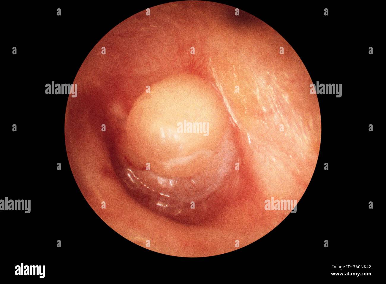 Ear infection. Otoscopy image of a blister on the eardrum of a child affected by acute ...