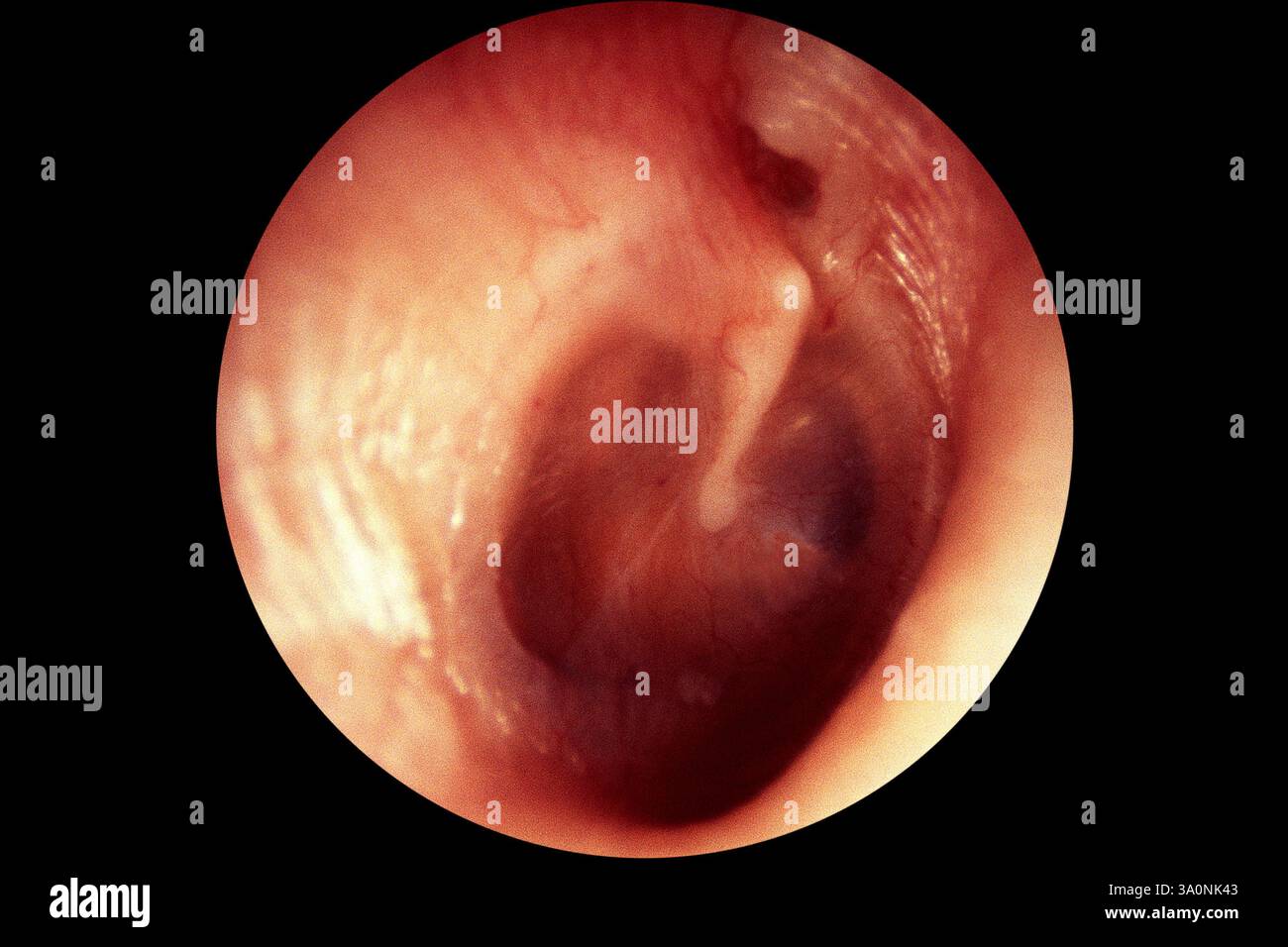 Ear infection. Otoscopy image of the interior of the ear of a child ...