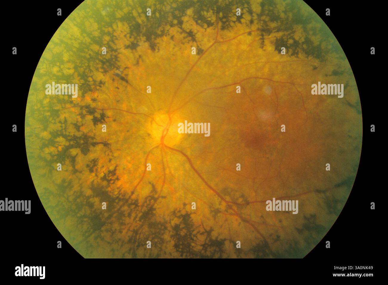 Pigmentary retinopathy. Fundoscopy image of the retina of a patient's ...