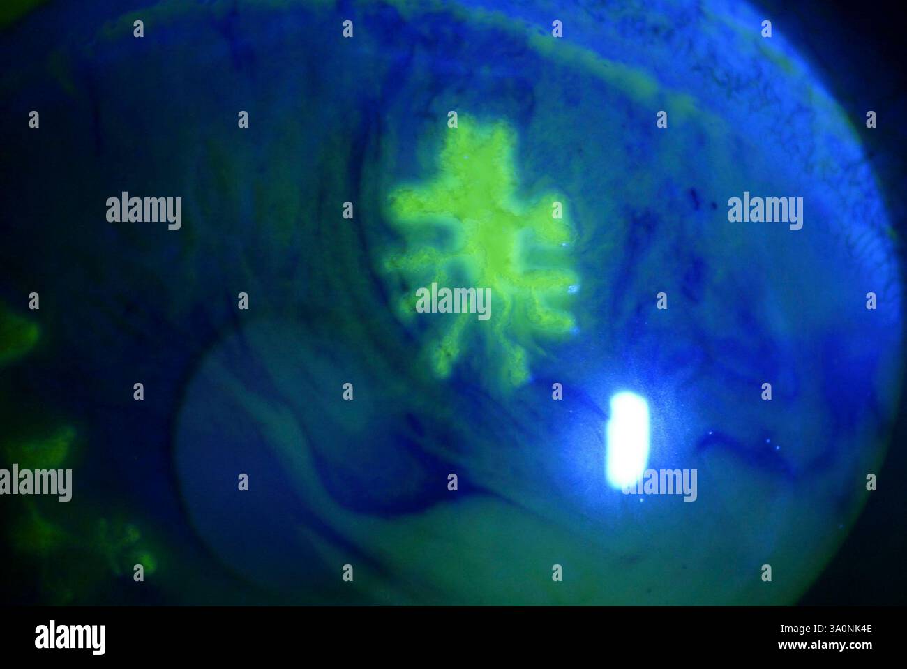 Herpes simplex keratitis. Fluorescein dye (with blue excitation) being ...