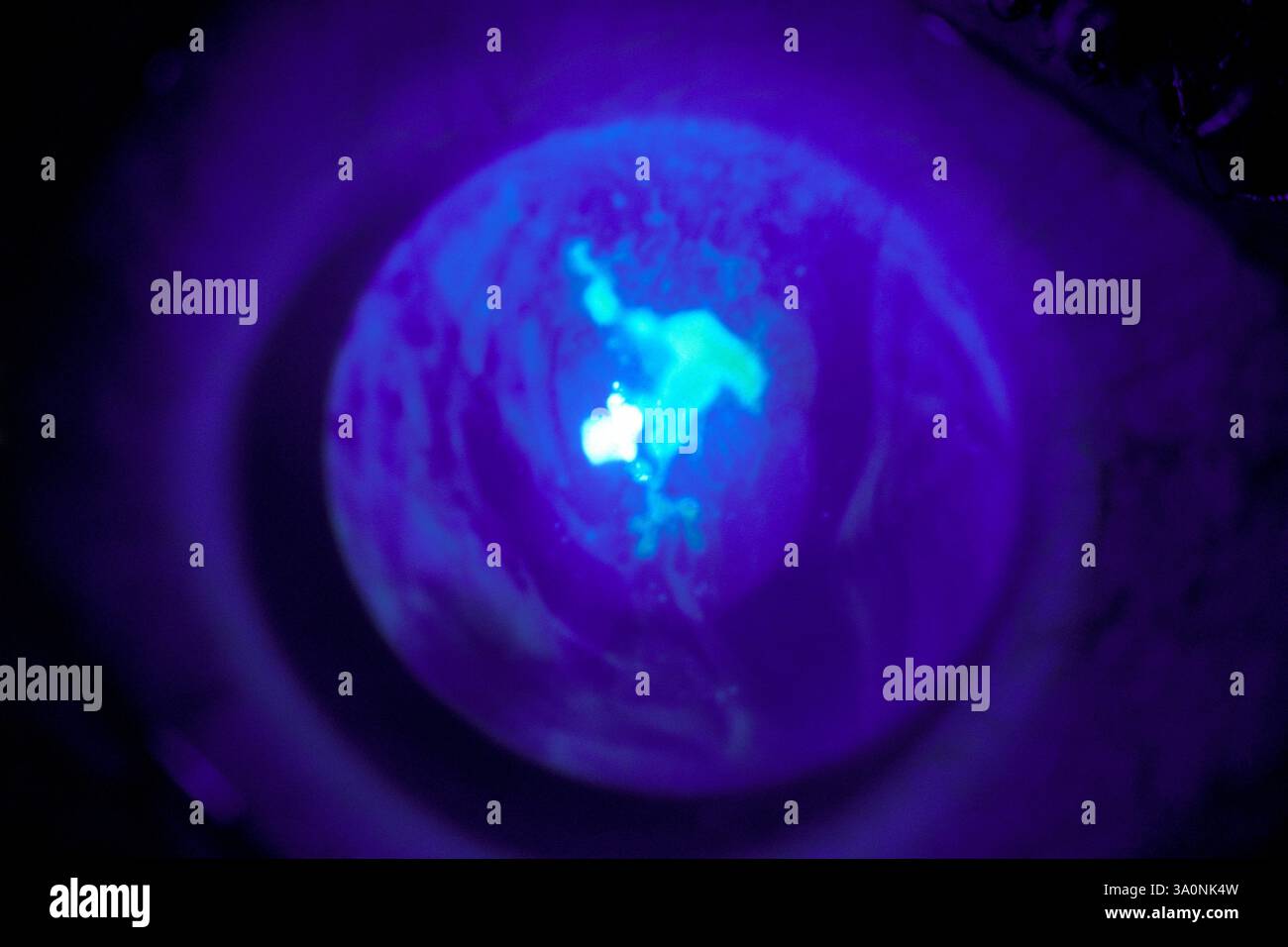 Herpetic corneal ulcer. Fluorescein dye (with blue excitation) being ...