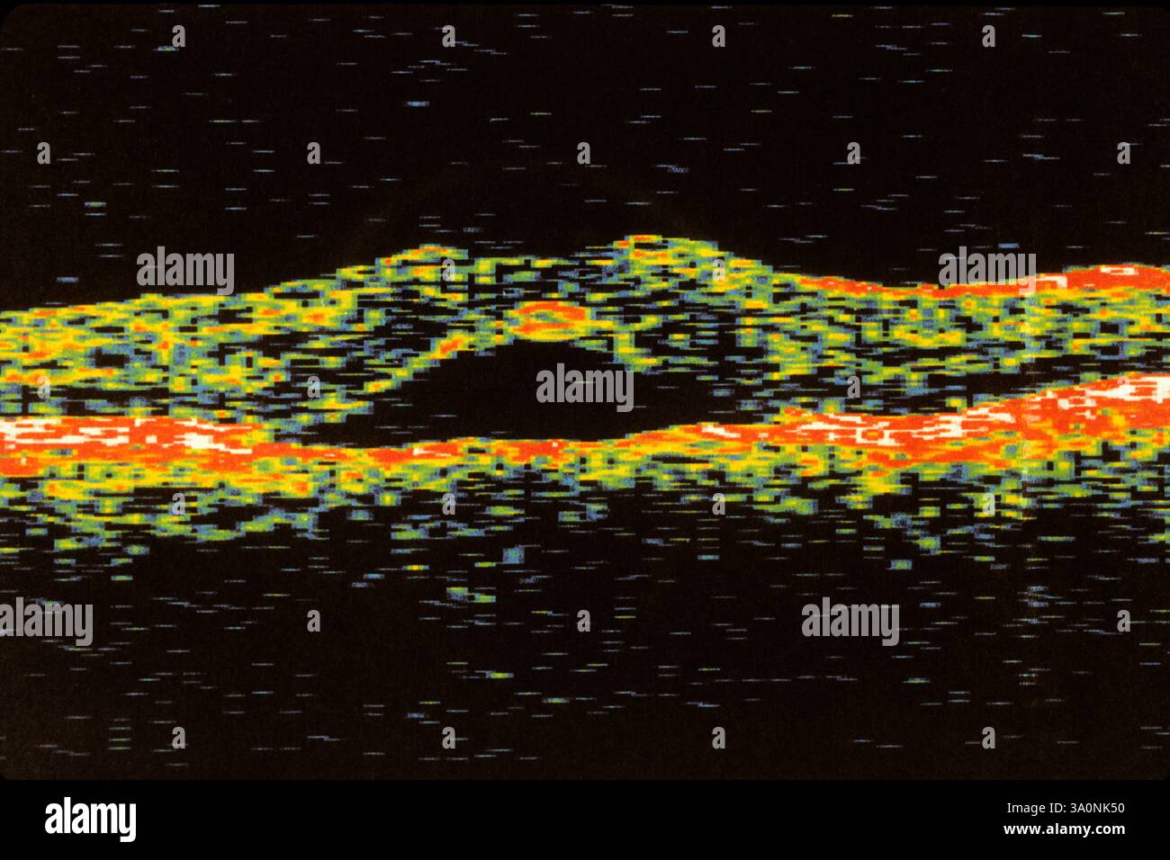 Central serous choroiditis. Optical coherence tomography (OCT) image of ...