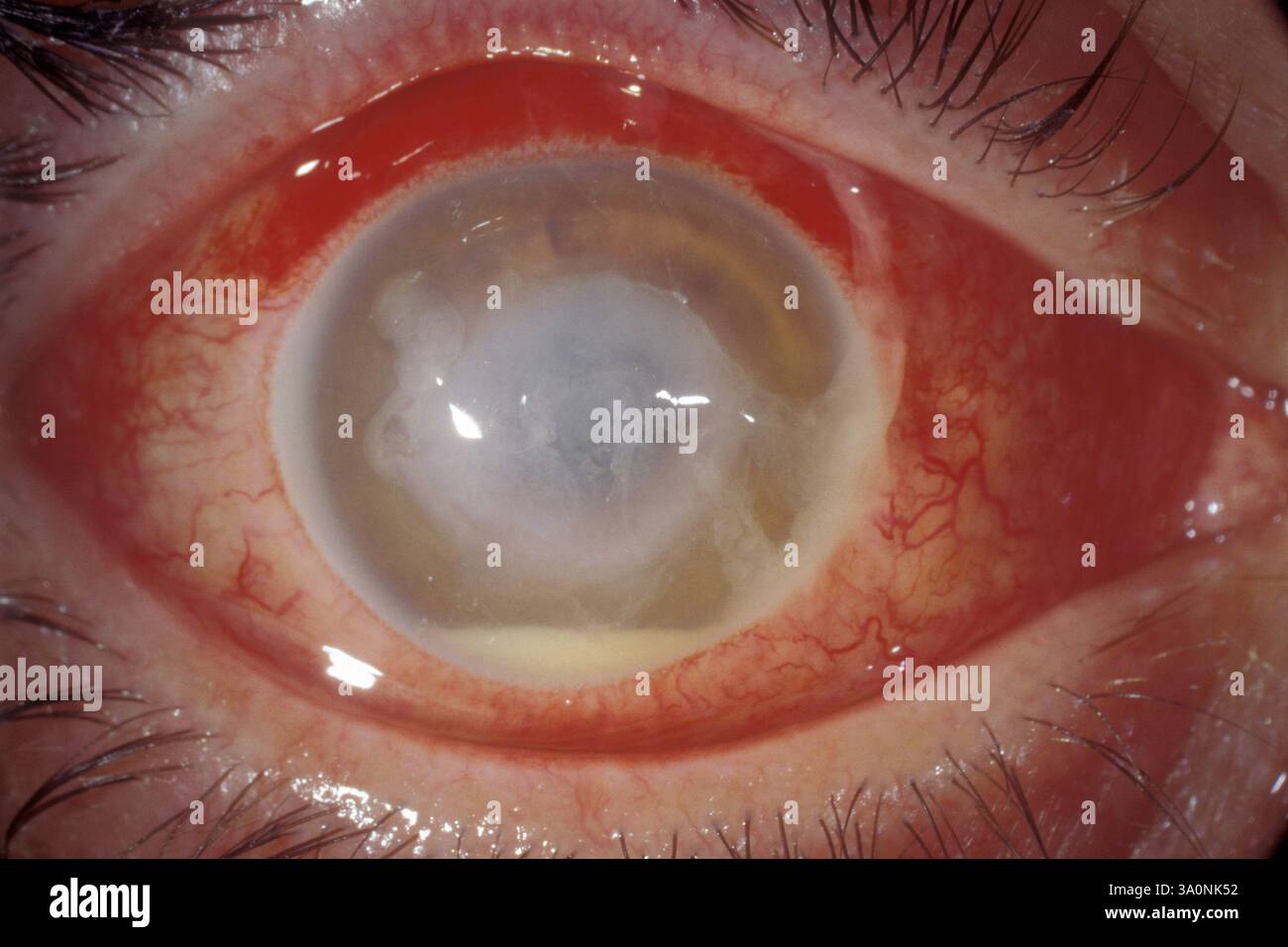 Corneal abscess and hypopyon. Close-up of the right eye of a patient ...