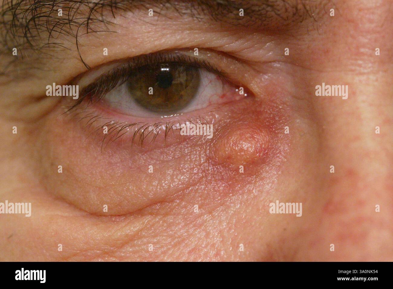 Infected tear sac. Close-up of chronic dacryocystitis of a man's right ...