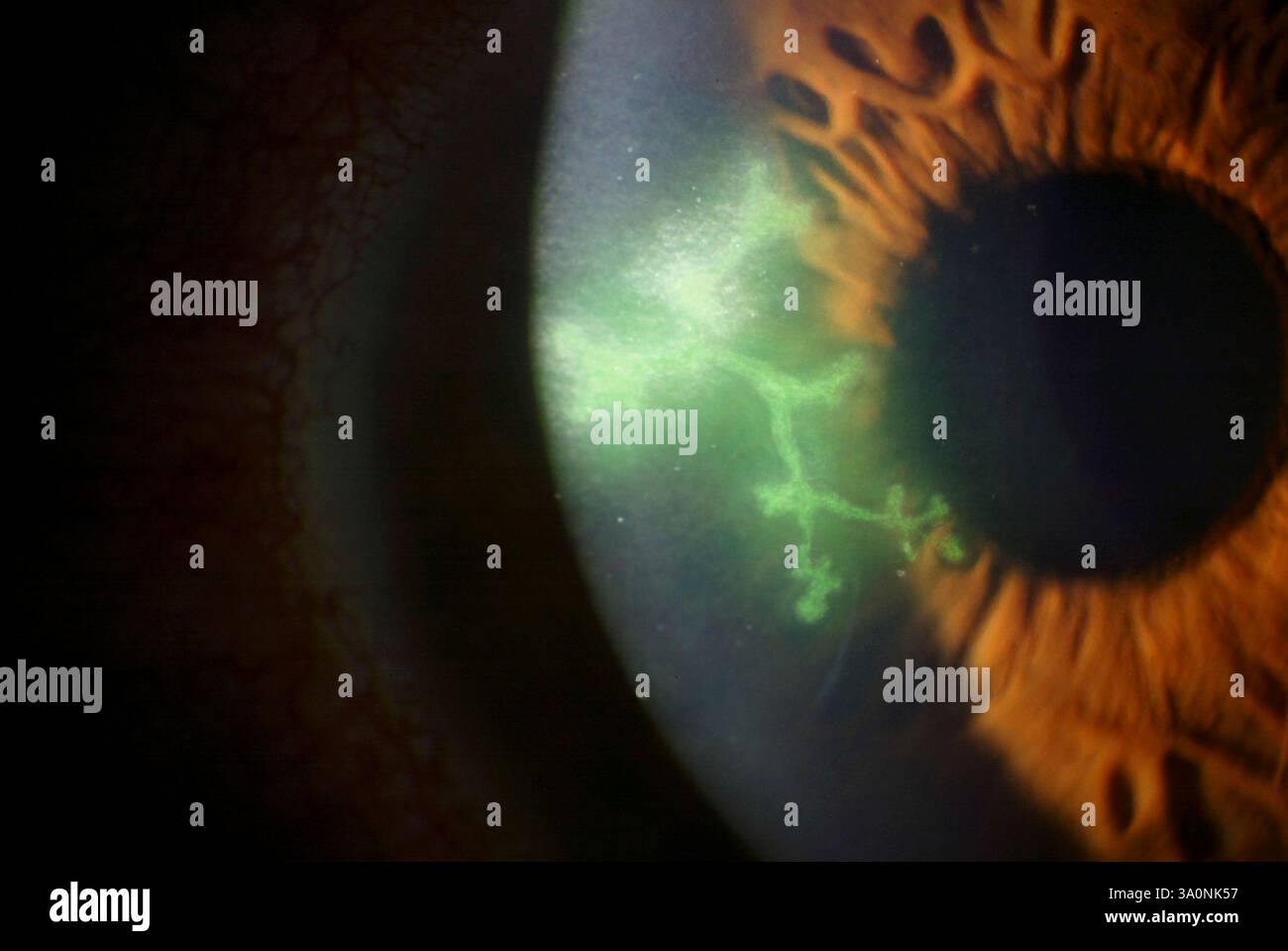 Herpes simplex keratitis. Slit-lamp examination of the cornea and iris ...